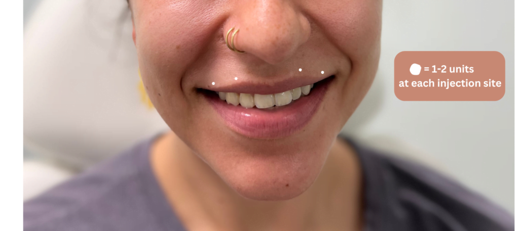 Everything you need to know about Botox lip flip - Organic Skin Studio